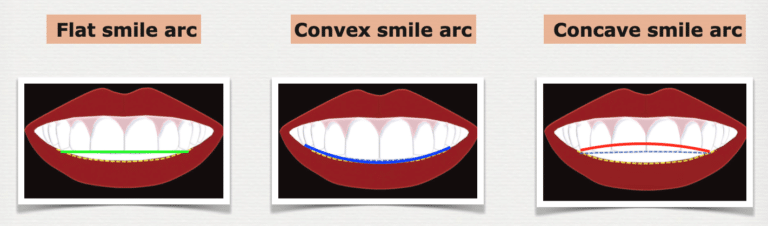 Bracket Position and Smile Line - สอนจัดฟันระบบ AVS